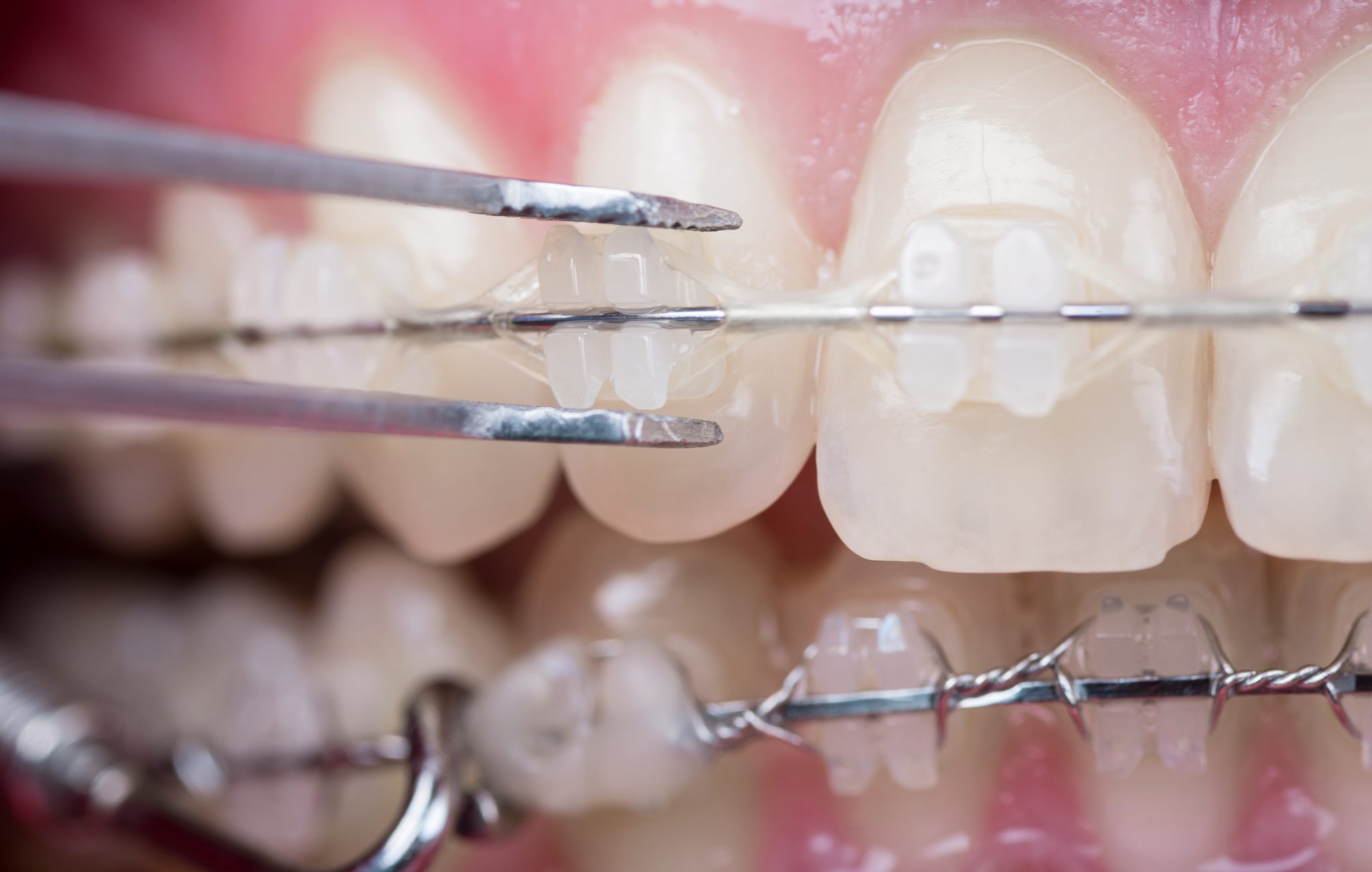 Orthodontics: Correction of Dental Misalignments and Bite Issues ...